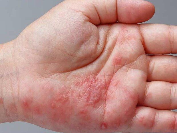 What is Tomato Flu? Causes, symptoms, prevention, and treatment ...