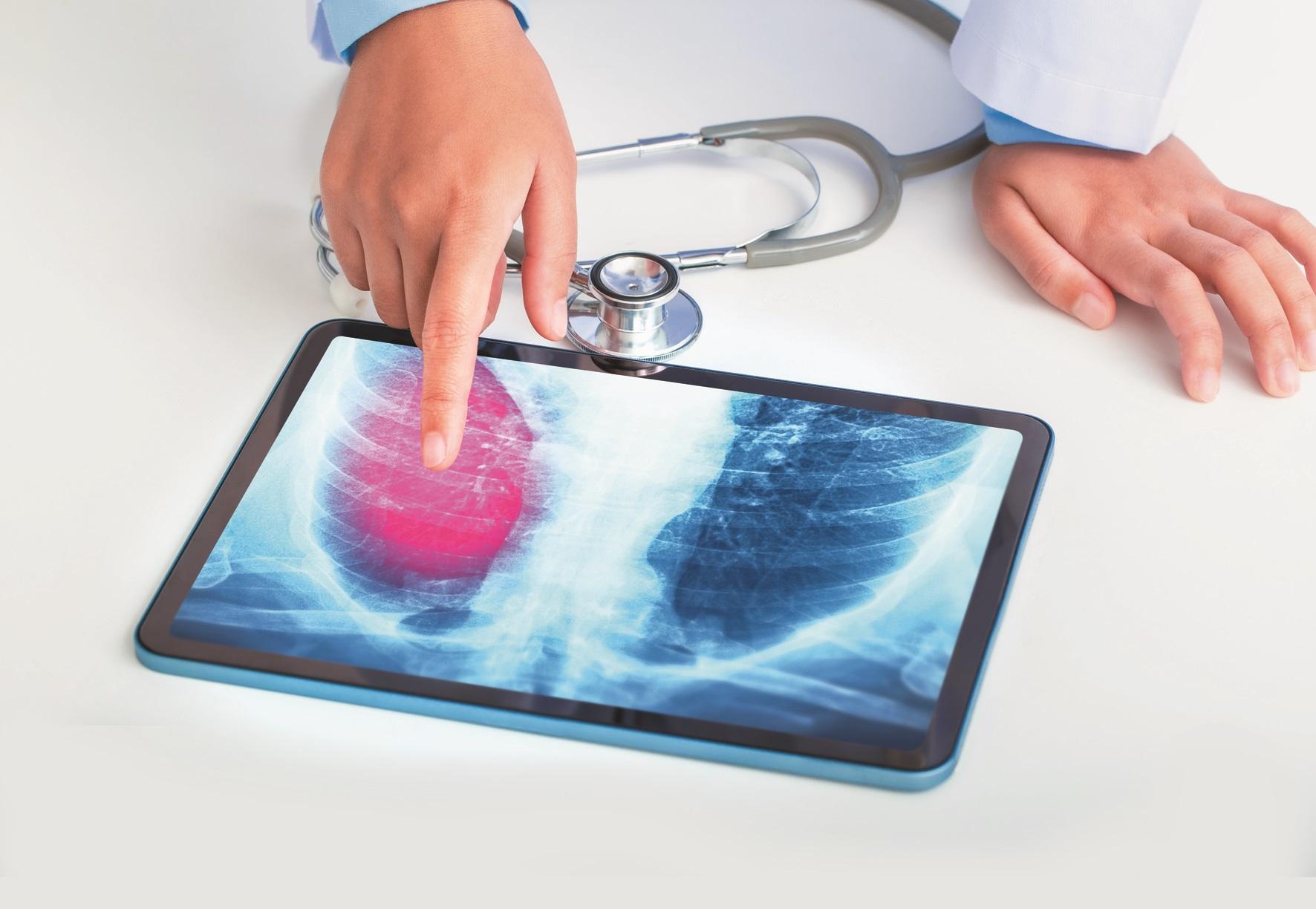 'Govt implementing largest digital programme for TB surveillance ...