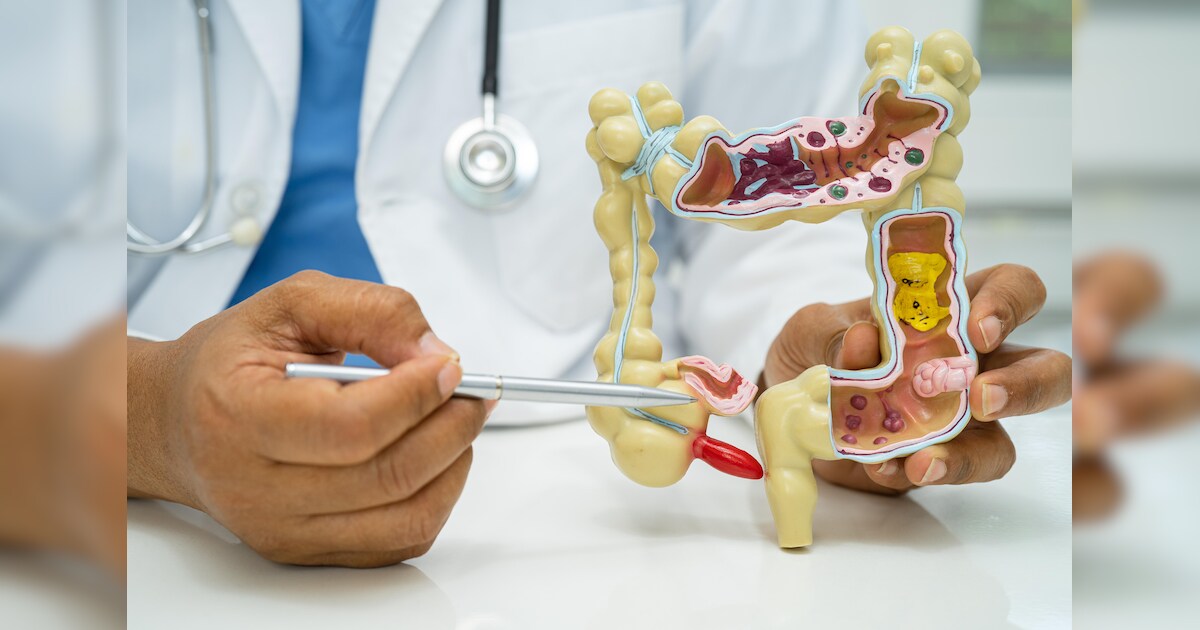 Appendix cancer rising among millennials and young: Know Causes, signs ...