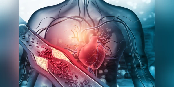 What is a double heart attack and why the second one is often more fatal | Health News ...
