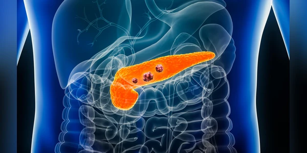 Why pancreatic cancer goes unnoticed, and what doctors want you to know ...